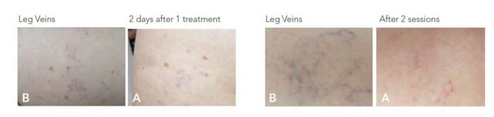 IPL Photofacial - Dr. Scott's Restorative Health & Aesthetics