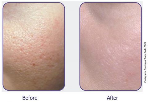 NeoGen PSR Plasma Treatment - Dr. Scott's Restorative Health & Aesthetics